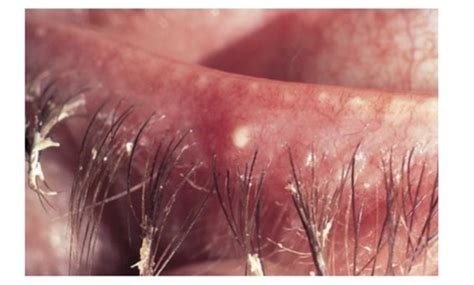 Anterior And Posterior Blepharitis Flashcards Quizlet