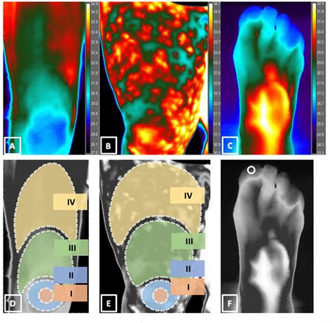 Figure 2 From Infrared Thermography Imaging For Assessment Of Peripheral Perfusion In Patients
