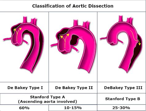 Aortic Dissection Cross Section