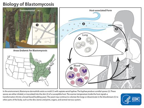 Blastomycosis Outbreak Inquiry Goes On At Billeruds Escanaba Mill