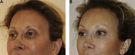 Periorbital Fat Grafting Facial Plastic Surgery Clinics