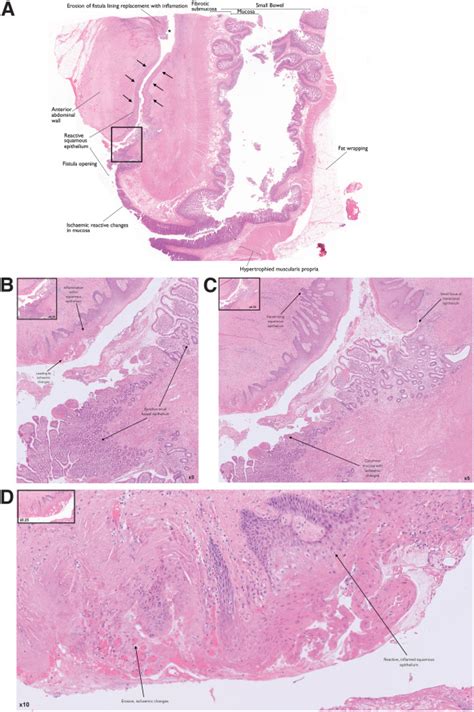 Pathogenesis Of Fistulating Crohns Disease A Review Cellular And