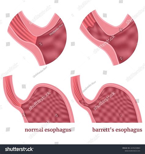 Barretts Esophagus Diagram Stomach Disease Medical Stock Vector Royalty Free 2235210863