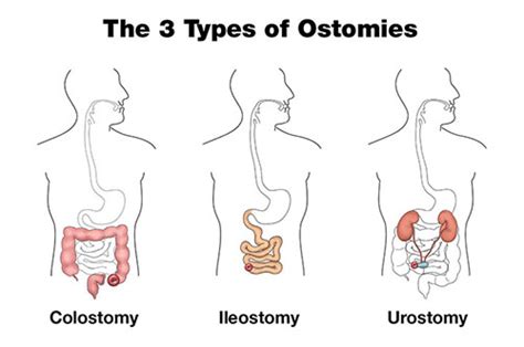 What Is A Stoma Ostomy Health Blog