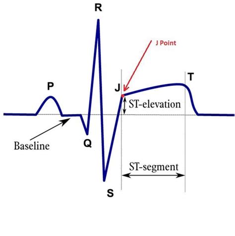 Code Stemi Activation For Paramedics V1 1 For Elearn 2023 By Clinical Education Issuu