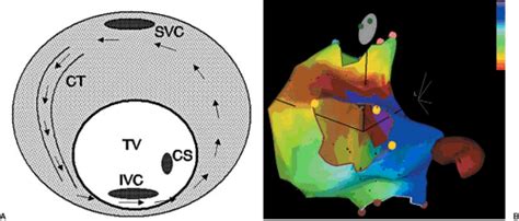 Atrial Flutter Thoracic Key