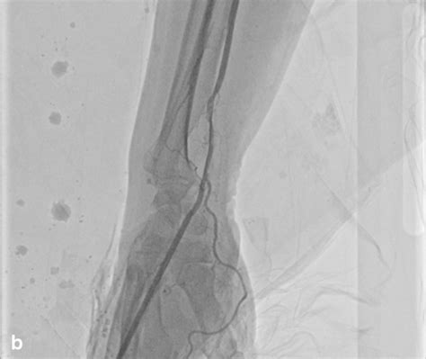 Angiogram Of The Radial Artery Resumed Download Scientific Diagram