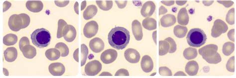 Eritropoiese Atlas Em Hematologia