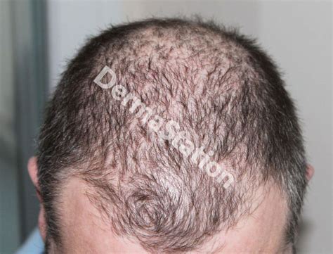 Androgenetic Alopecia Pattern Hair Loss