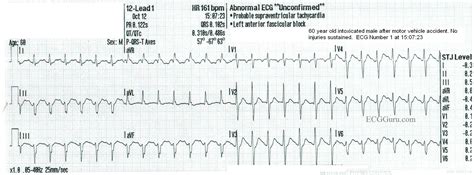 Teaching Series Tachycardia And Left Anterior Fascicular Block Ecg Guru Instructor Resources