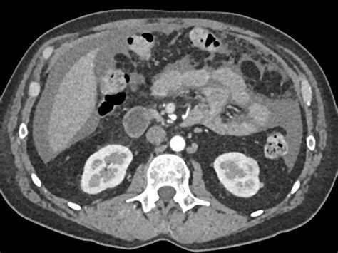 Ctisus On Linkedin Gastric Cancer With Carcinomatosis Ezue28y8