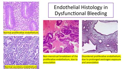 Vaginal Bleeding Flashcards Quizlet