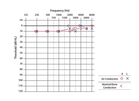 Imageaudiogram Of Right Ear In A Patient With Normal Hearing Msd