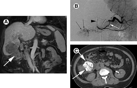 Technical Aspects Of Radioembolization With 90y Microspheres Techniques In Vascular