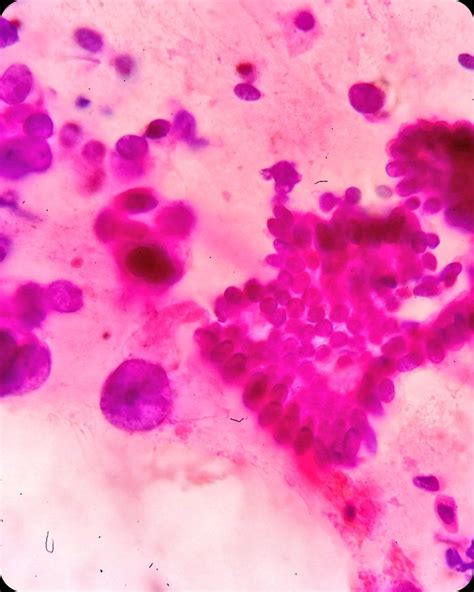 🪥 Biliary Track Brushing Héctor Enrique Torres Rivas