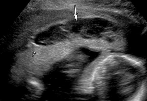 Placental Imaging Normal Appearance With Review Of Pathologic