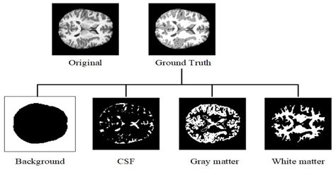Dissimilarity Corrective Generative Adversarial Network For Brain Image Segmentation