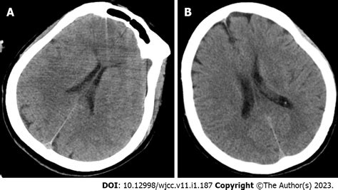 Hyponatremic Encephalopathy Due To Polyethylene Glycol Based Bowel