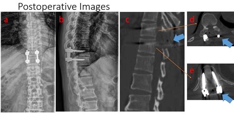 Laminectomy For The Removal Of Thoracic Ossification Of The Ligamentum Flavum Tolf Using