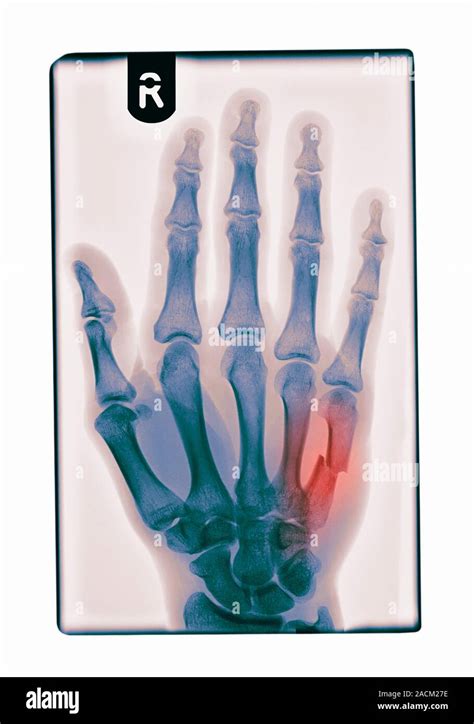 Broken Metacarpal Bone Coloured X Ray Of The Bone Of A Patients Right