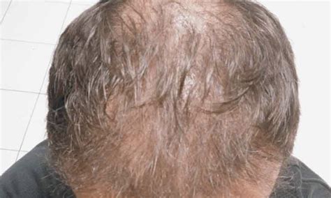 3 Months After Hair Transplant Hairback Clinic