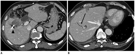 Safety And Efficacy Of Ultrasound Guided Fiducial Marker Implantation For Cyberknife Radiation