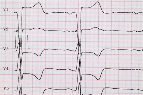 Subendocardial Infarction Ecg