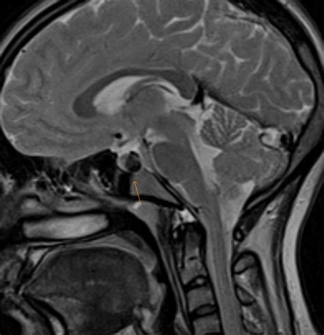 Rathkes Cleft Cyst Mri Sumers Radiology Blog