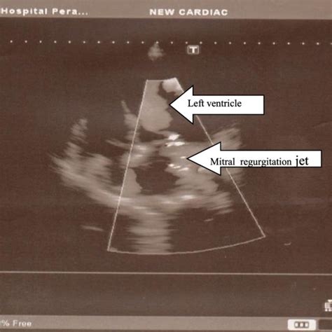 2d Echocardiogram Showing Mitral Regurgitation Download Scientific
