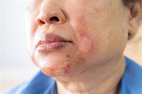 红斑狼疮是什么原因引起的病症有哪些症状 39健康网 风湿科