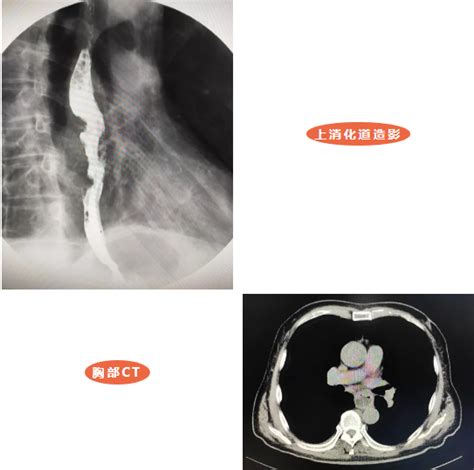 小切口，大手术——宝高医首例全腔镜下微创食管癌根治术 宝鸡高新医院