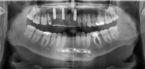 Understanding Bone Resorption Causes Complications And Regeneration Treatments Implant Perio