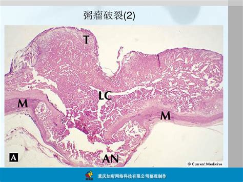 动脉粥样硬化病理图谱 Word文档在线阅读与下载 无忧文档