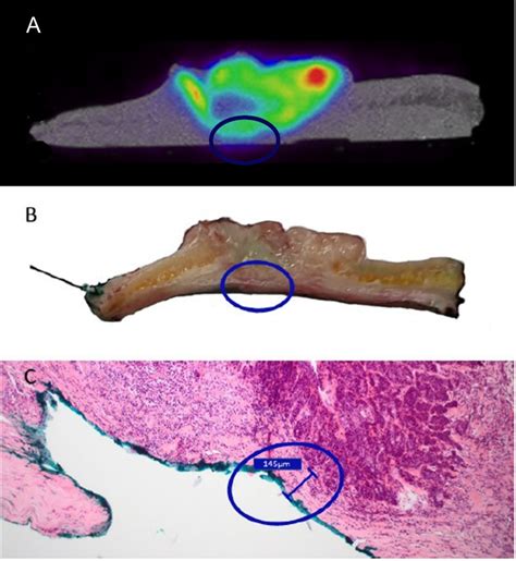 Imaging Case 6 Head And Neck Squamous Cell Carcinoma Of The Scalp
