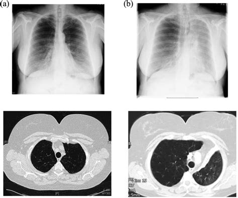 Clinical Review Endobronchial Valve Treatment For Emphysema Pmc