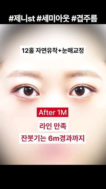 쌍수 상담 때 제니 사진 보여준 결과 Shorts Youtube