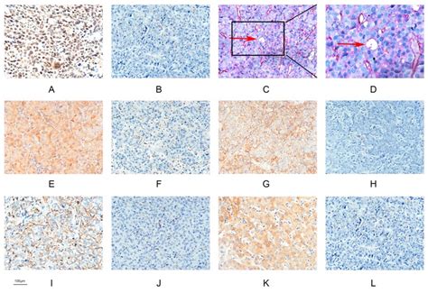 The Expression And Functional Significance Of Runx2 In Hepatocellular