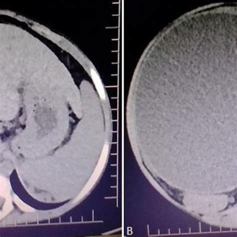 A B Triphasic Ct Scan Of The Abdomen Showed A Well Defined Download Scientific Diagram