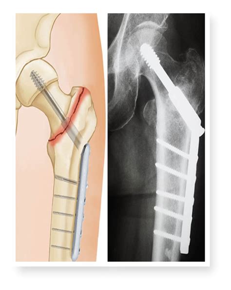 Hip Fracture Treatment Dr Rahul Puri