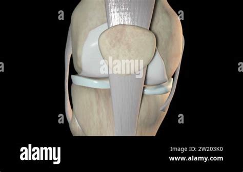 Patella Fracture Stock Videos And Footage Hd And 4k Video Clips Alamy