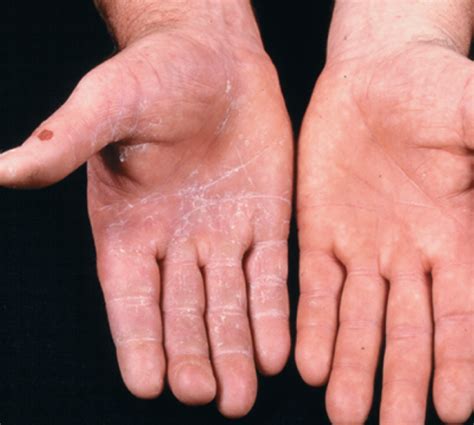 Tinea Pedis Hands