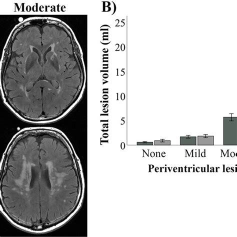 White Matter Lesion Severity Large Individual Differences In Lesion Download Scientific Diagram