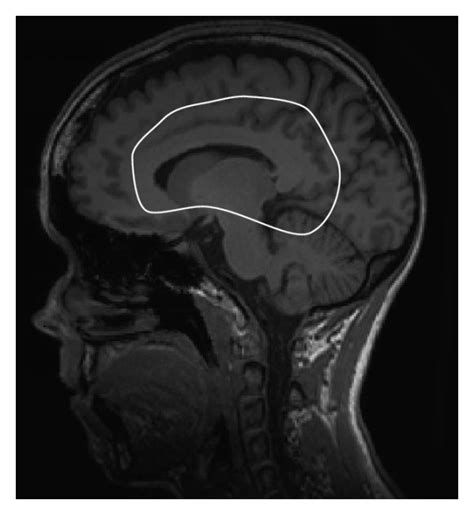 Segmentation Of The Brain Surface Using Deformable Models A A Closed