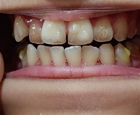 Help Please My Teeth Look Weird Rinvisalign