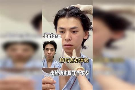 第一次做热玛吉 难免有些紧张哈哈哈哈