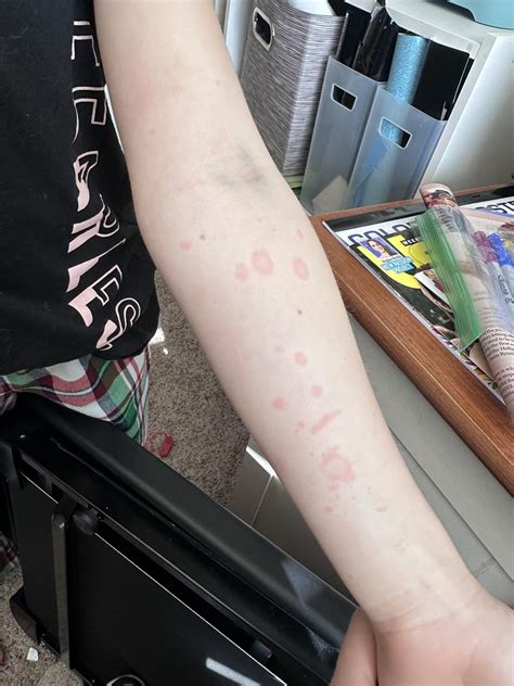 Unexplained Rash On 9 Yo Rdermatologyquestions