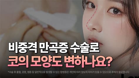 비중격 만곡증 수술 비염 수술을 하면 코 모양도 변할까요 🤧 Youtube