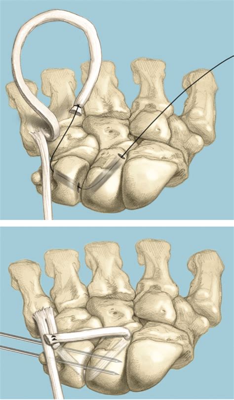 Extensor Carpi Ulnaris Tenodesis Thomas R Hunt Iii Md Dsc