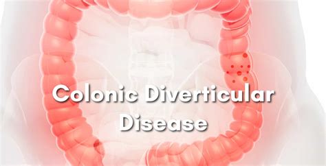 Vasa Recta Diverticulosis