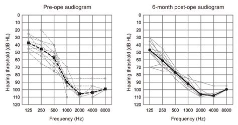 Video Author Spotlight Optimizing Eas With Long Electrodes For